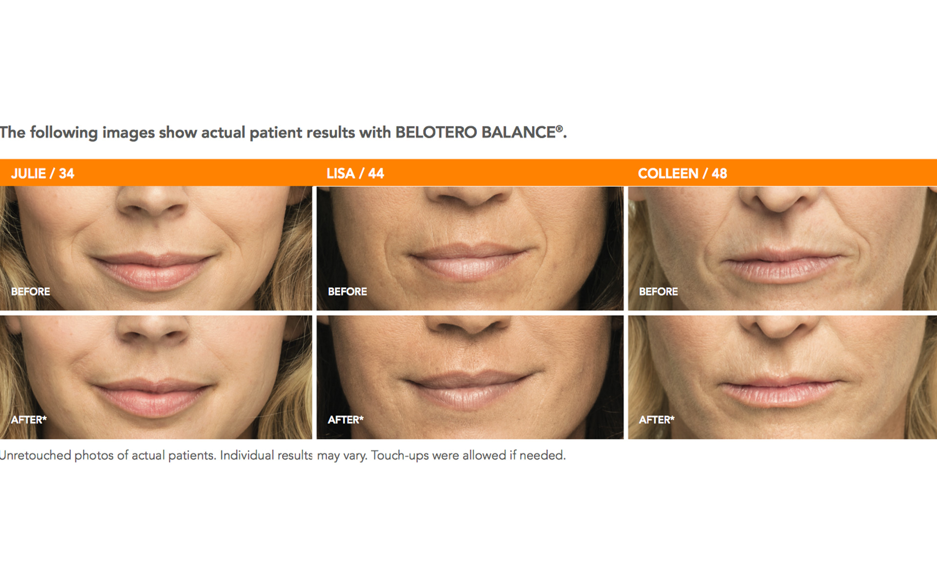 Belotero Filler | Facial Sculpting - Aesthetic Clinic Kuala Lumpur ...